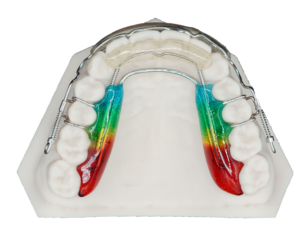 Inman Aligner Upper - Protec Dental