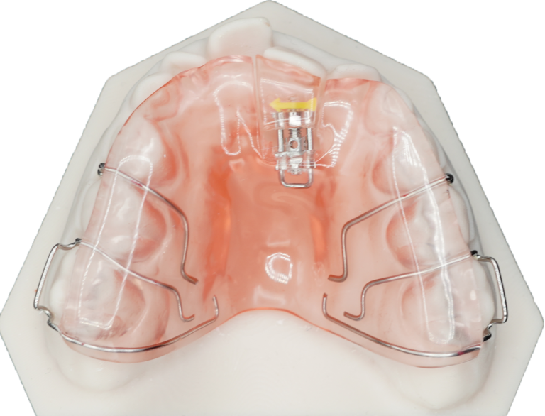 Crossbite Screw - Protec Dental
