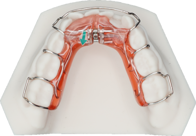 Schwarz Appliance Lower - Protec Dental