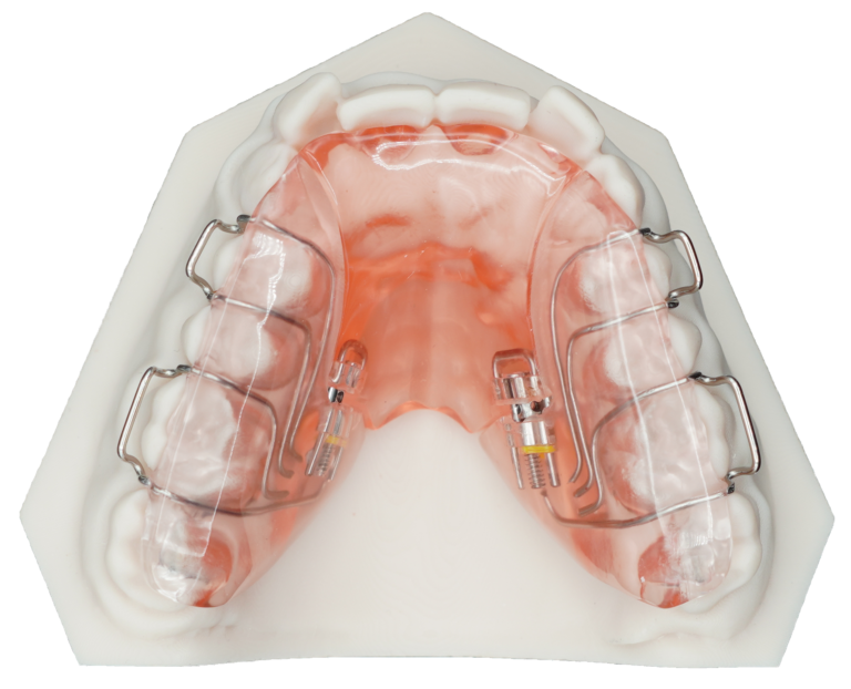 Sagittal Appliance Upper - Protec Dental