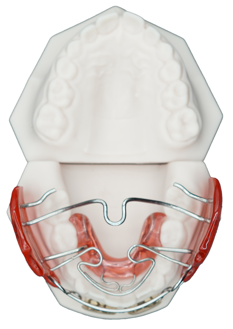 Frankel Appliance - Protec Dental