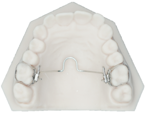 Transpalatal Arch - Protec Dental
